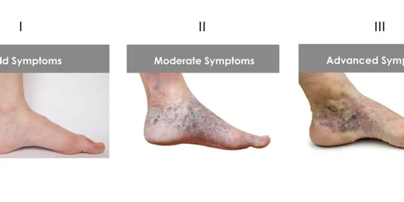 3 Stages of Venous Insufficiency