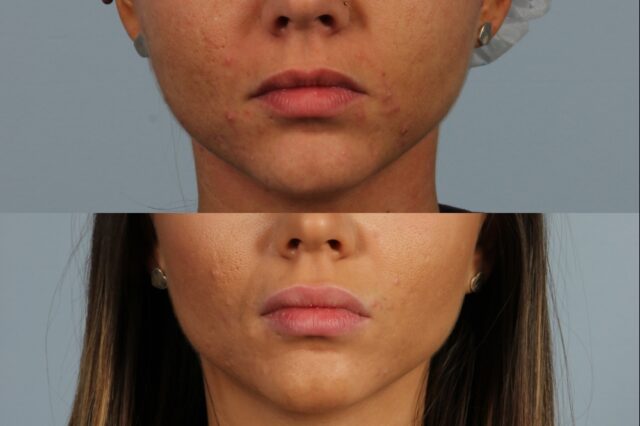 Lip Fillers - Allure Medical | Vein Treatment, Cosmetics and More
