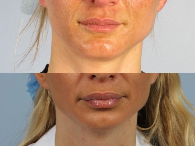 Lip Fillers - Allure Medical | Vein Treatment, Cosmetics and More
