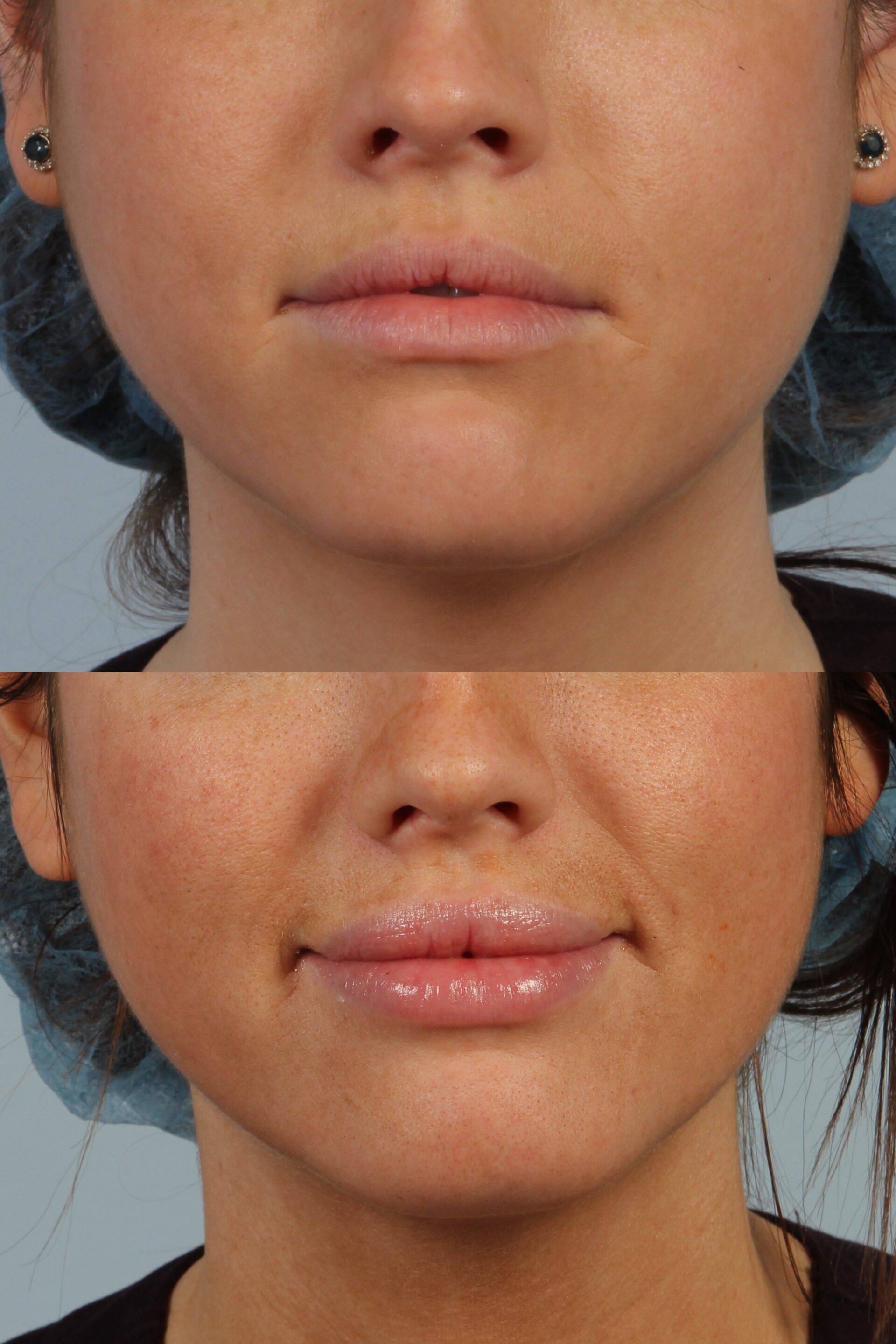 Lip Fillers - Allure Medical | Vein Treatment, Cosmetics and More