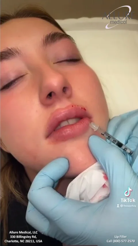 Lip Fillers Near Me in Charlotte, NC - Plump Your Pout | Allure Medical