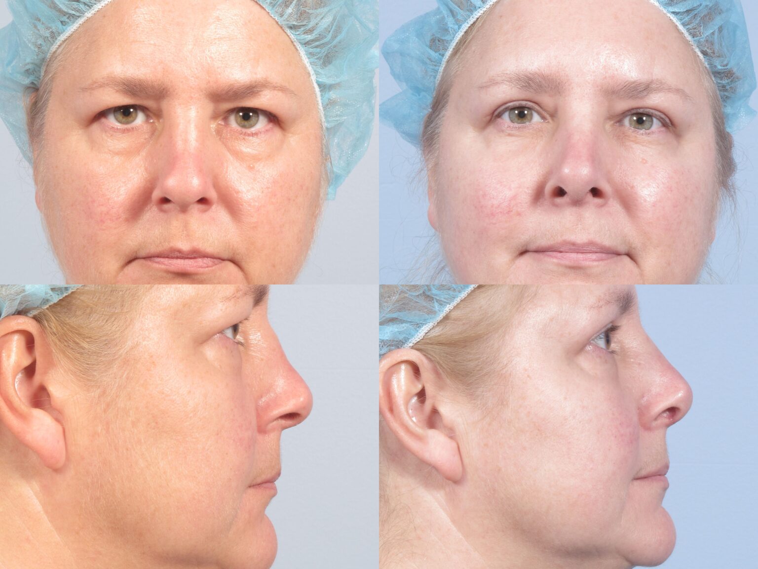 Dermal Fillers
