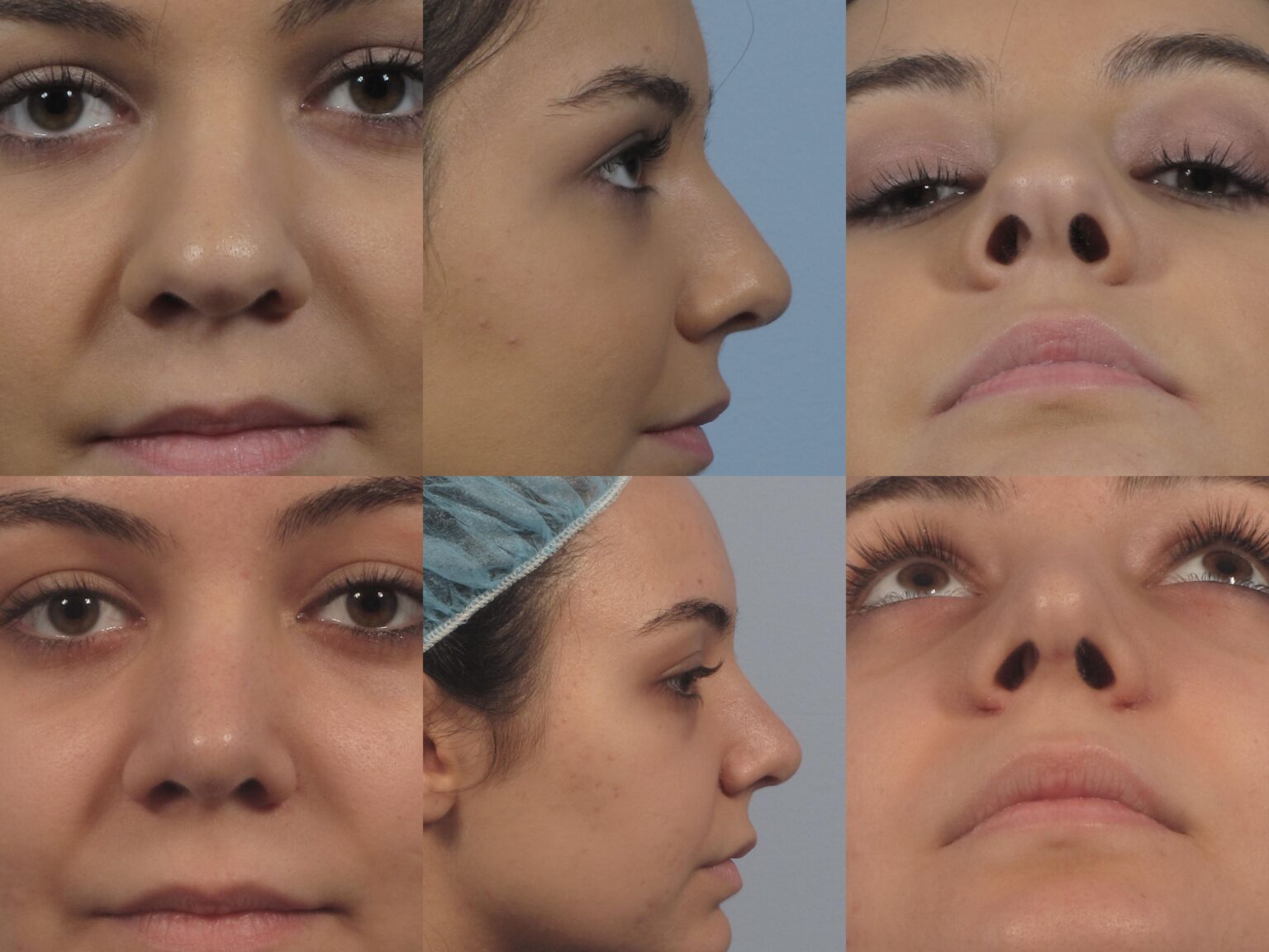 Dermal Fillers